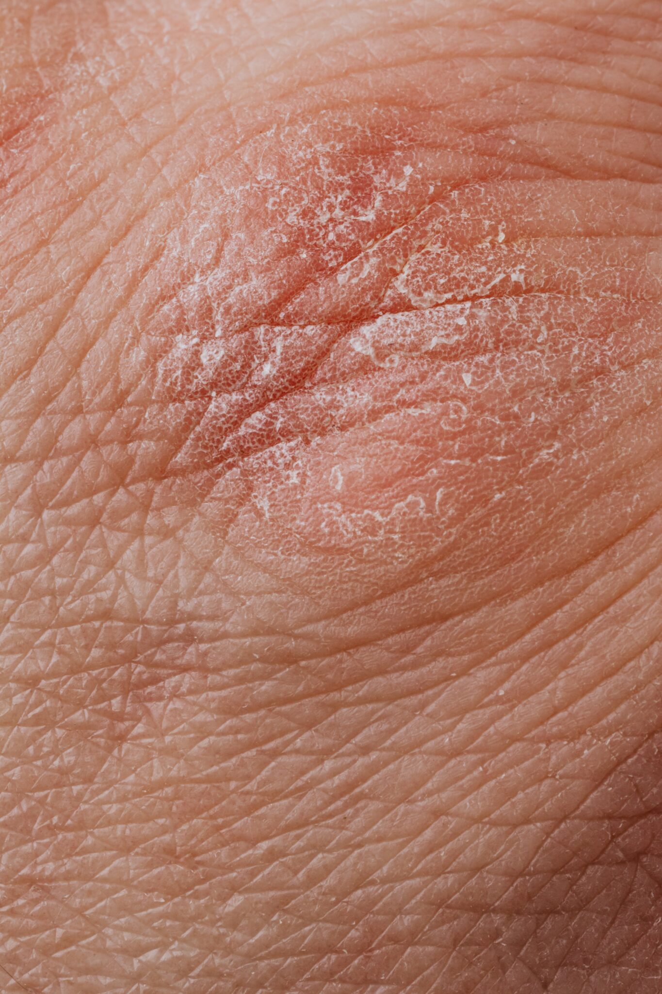 Diagnose - Allergie: Allergiepraxis Basel | Dr. med. Yves D. Cahen